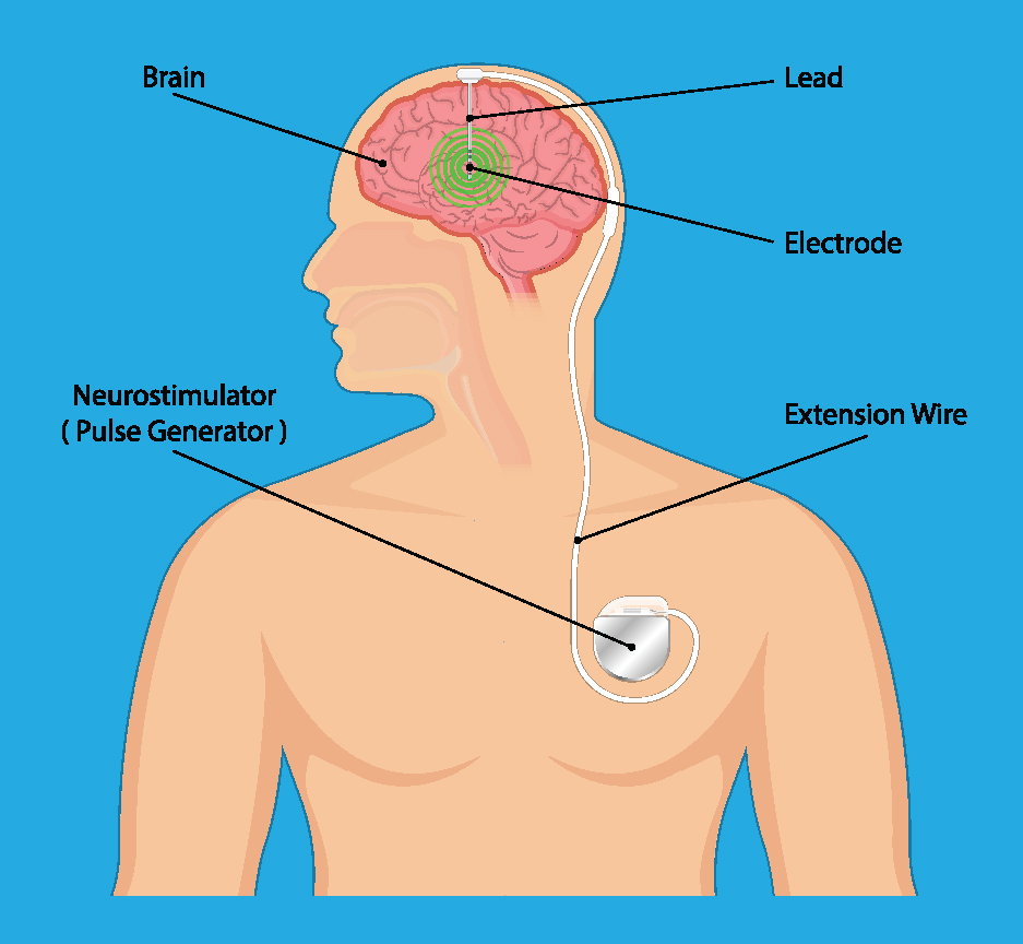 Deep Brain Stimulation Relief From Movement Disorders Michigan Head
